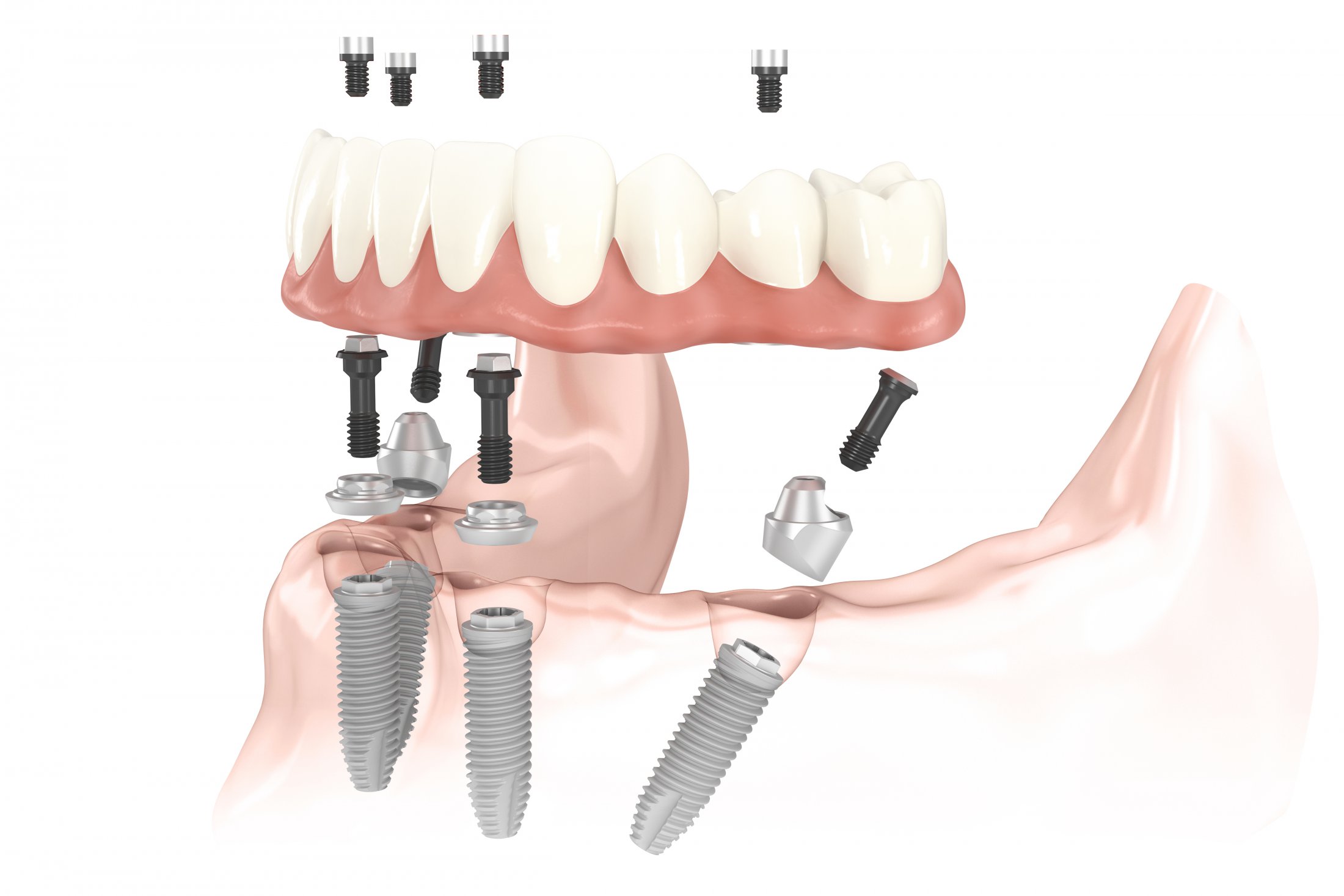 The All-on-4® Treatment Concept Randolph Center for Oral ...
